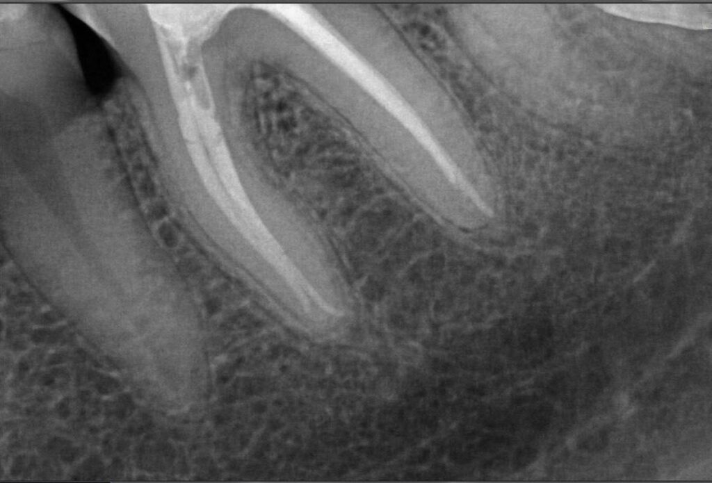 Molar root canal treatment in Miami – pricing and scheduling an appointment