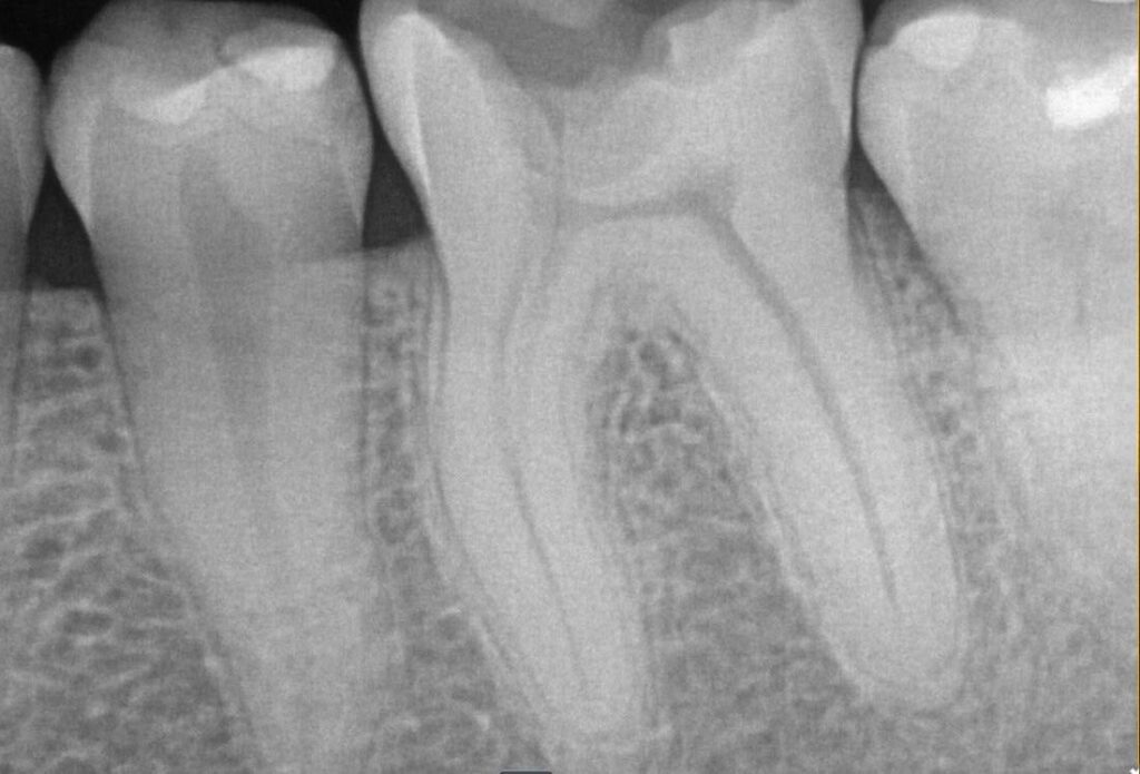 Molar root canal treatment in Miami – pricing and scheduling an appointment